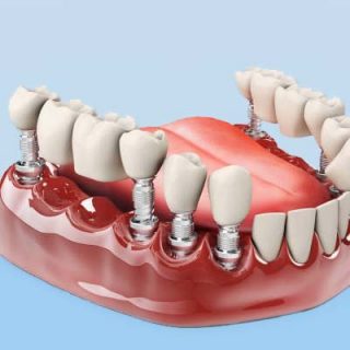 3 reasons dental implant bridges are better