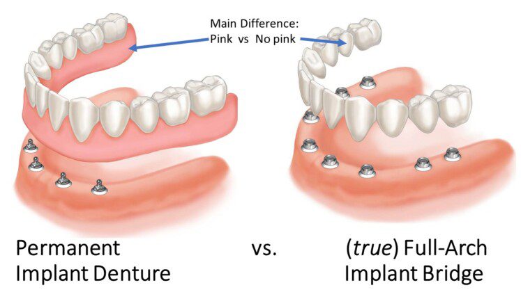 Fixed Bridges vs Fixed Dentures - The Complete Guide