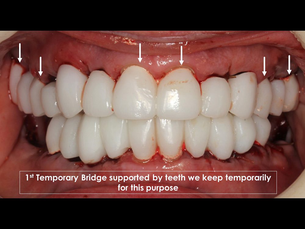 Implant Bridges: What is the process? - Dental Implant Center