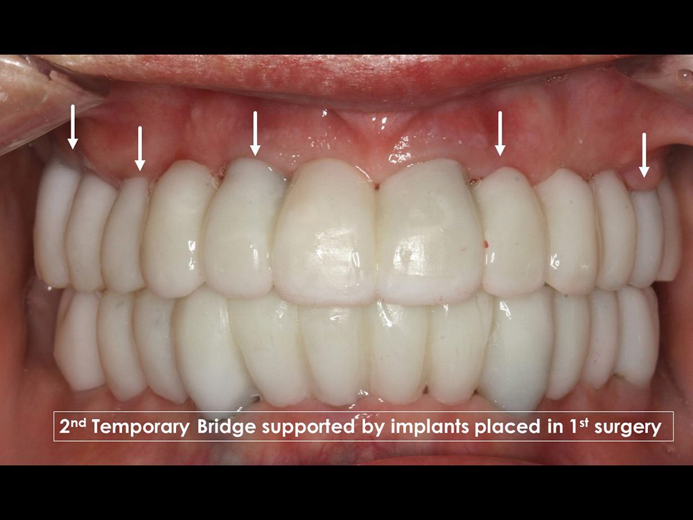 Implant Bridges: What is the process? - Dental Implant Center