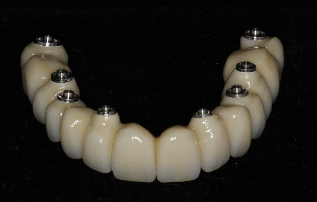 Fixed Bridges vs Fixed Dentures - The Complete Guide