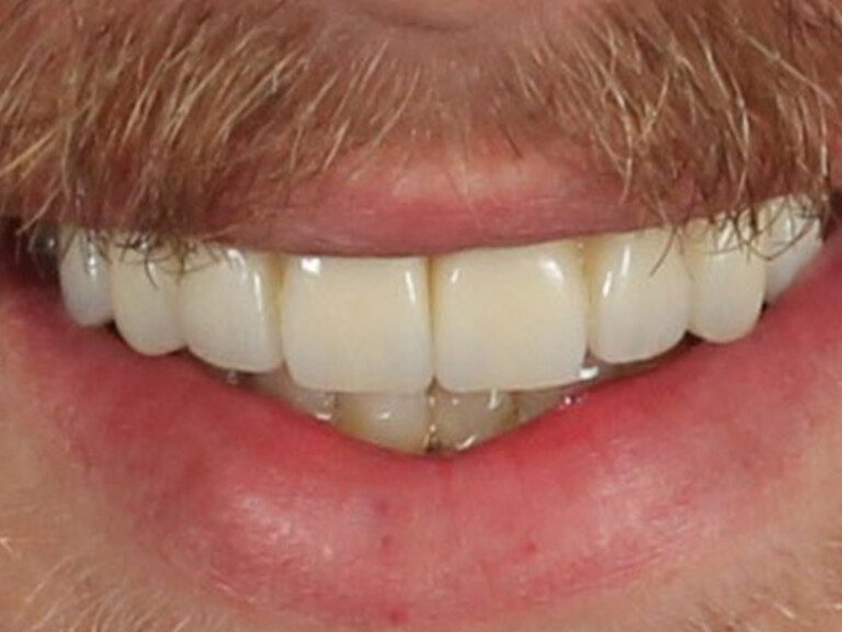 Fixed Bridges vs Fixed Dentures - The Complete Guide