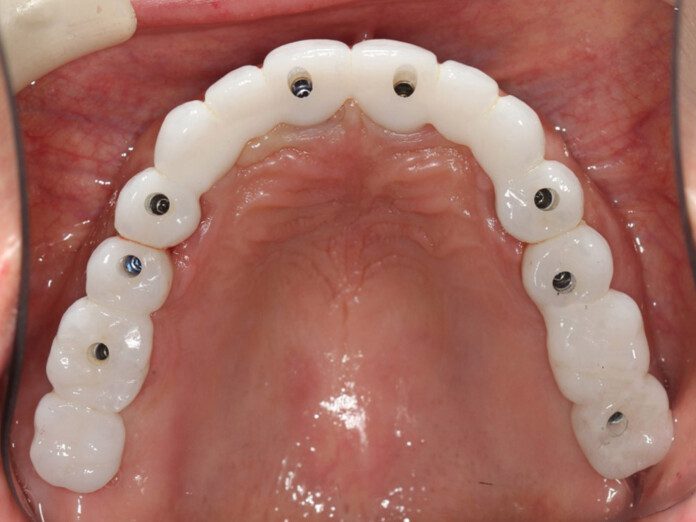 Implant Bridges: What is the process? - Dental Implant Center