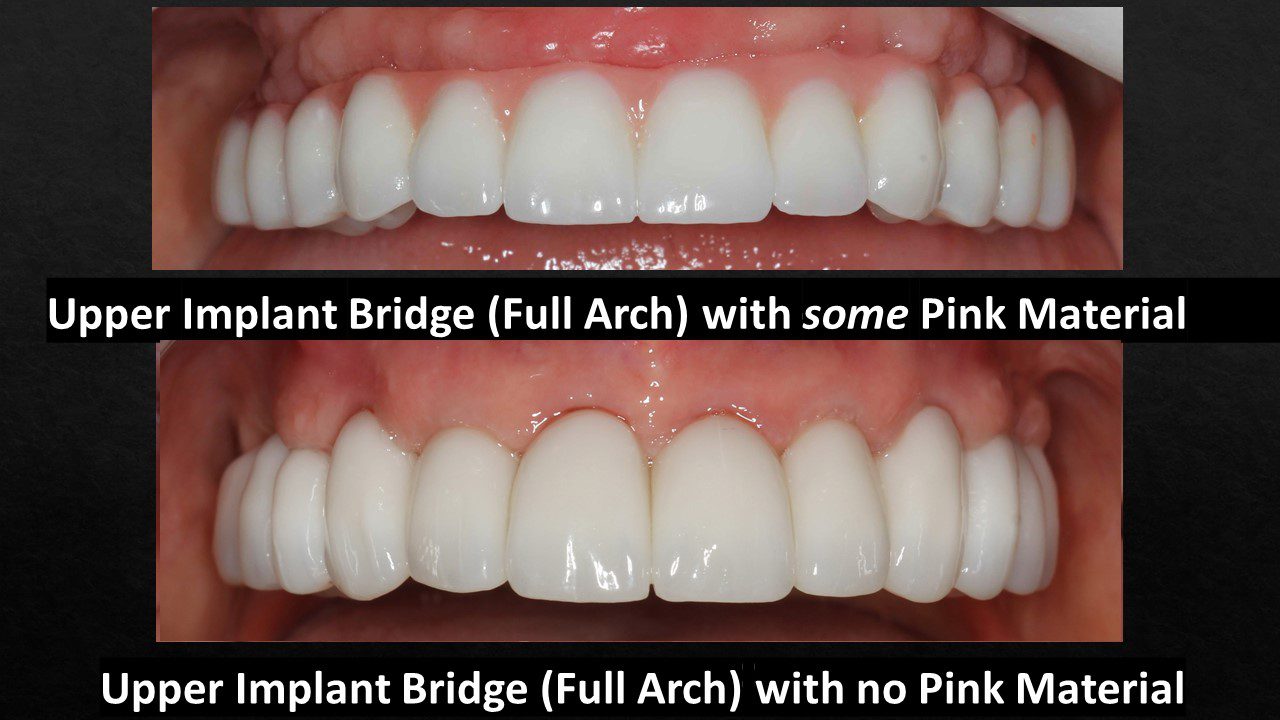 Fixed Bridges vs Fixed Dentures - The Complete Guide