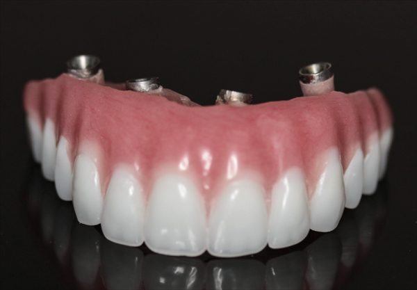 Fixed Bridges vs Fixed Dentures - The Complete Guide